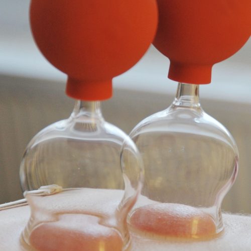 In The News: Fire Cupping Therapy - Shambhala Wellness Center